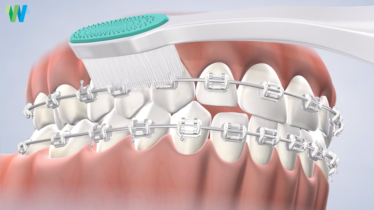 Braces Care Instructions at Warren Orthodontics, Springville, UT