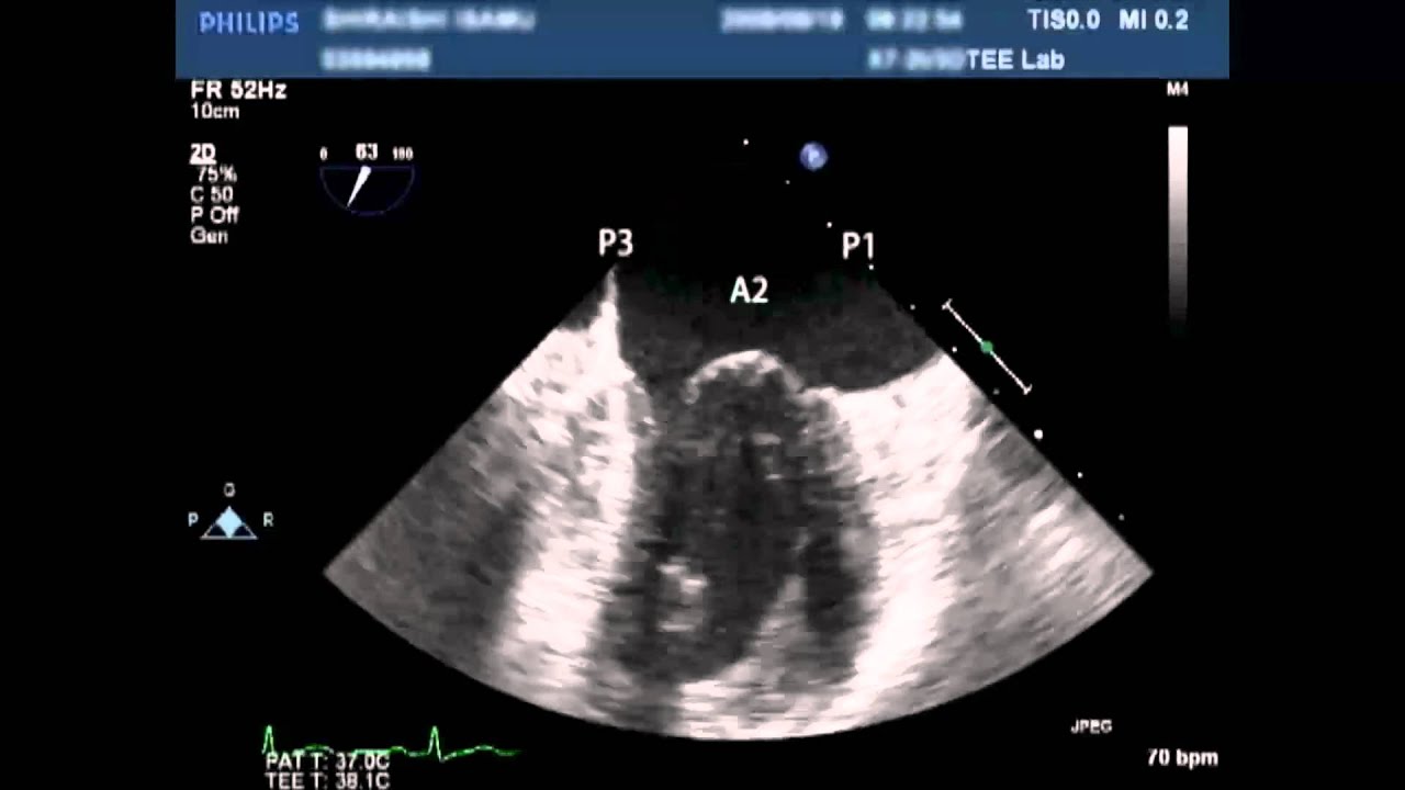 A2 ME mitral commissural