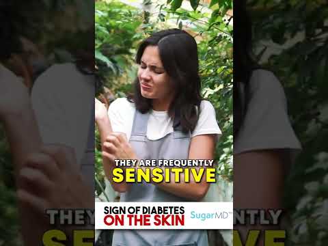 Eruptive Xanthomatosis | Sign of Diabetes on The Skin