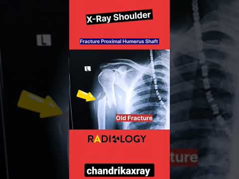 Fracture Humerus Bone | X-ray shoulder #radiology #xray @chandrikaxray