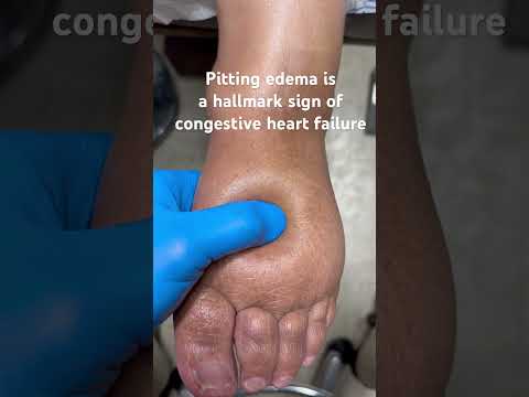 Pitting Edema Is A Sign Of Congestive Heart Failure
