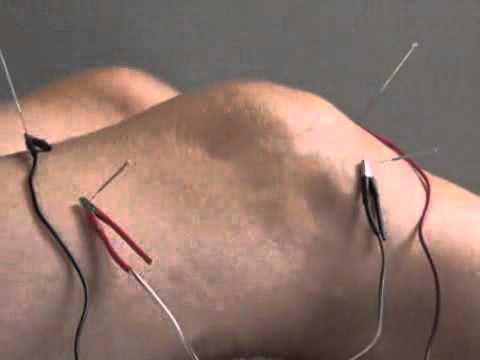 Complementary Therapies - Chinese Acupuncture Clinic