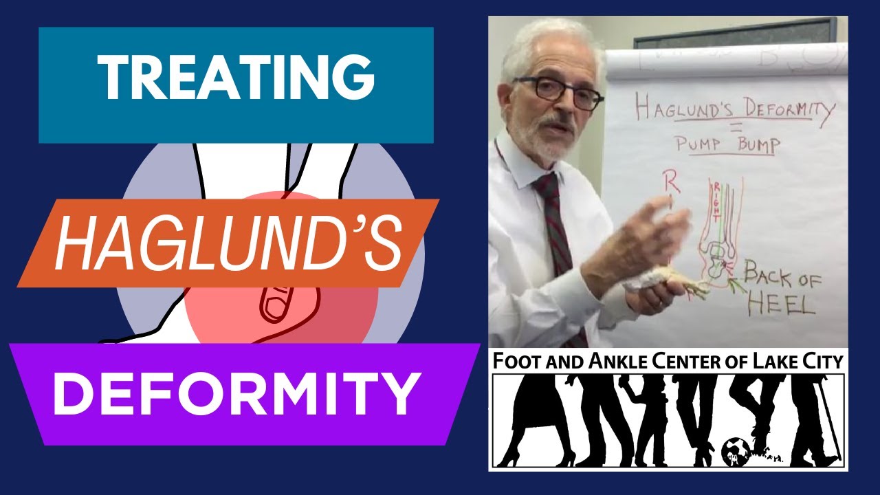 What Is Haglund's Deformity and How Is it Treated? | Foot and Ankle ...