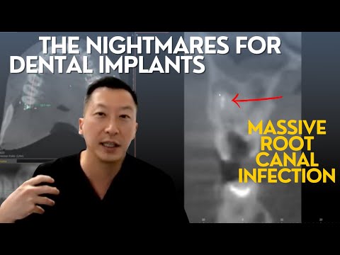 Failed Root Canals and Why They can be Nightmares for Dental Implants