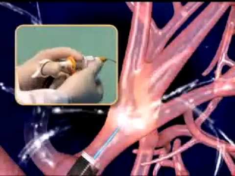 Electromagnetic Navigation Bronchoscopy - Cabell Huntington Hospital