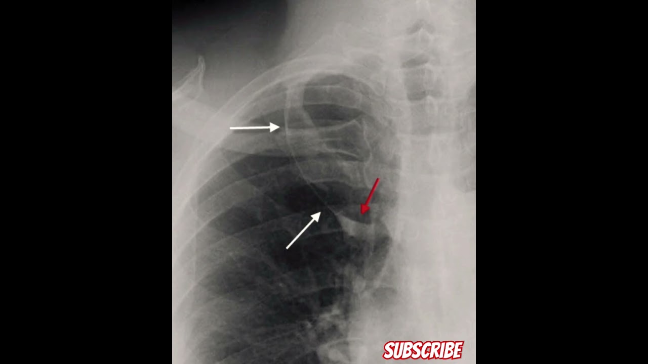 Azygos lobe & Azygos fissure - Basic Radiology