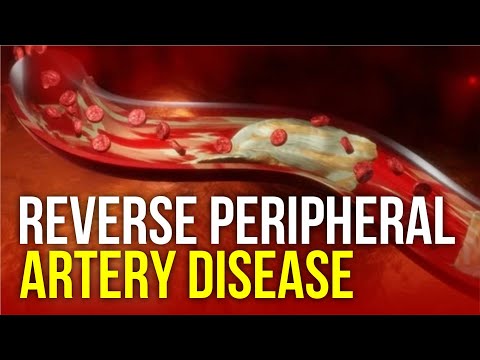 How Can You Reverse Peripheral Artery Disease? #legpain