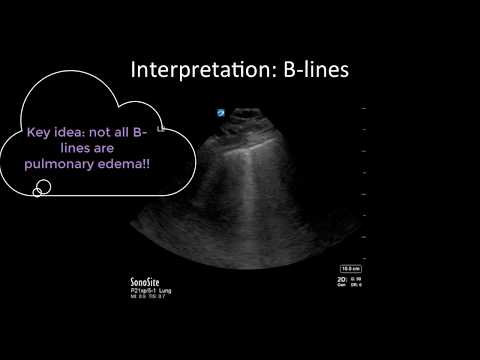 Pitfalls of Lung Ultrasound