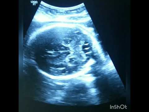 Ultrasound video showing a Blake's Pouch cyst in a fetus of 28 weeks