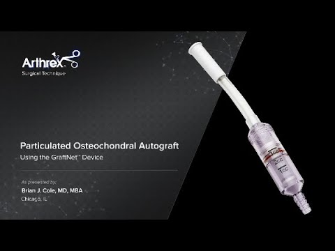 Particulated Osteochondral Allograft Using the GraftNet Device™