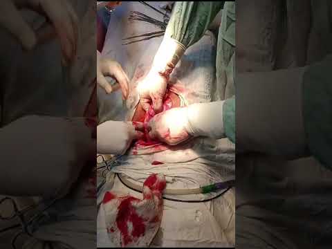 Spanner, nut bolts found in belly @operation crazy @real लोहा खाने वाला का आप्रेशन #पेट में नट बोल्ट
