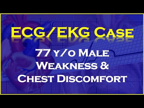 ECG/EKG Case: 77 y/o male with weakness and chest discomfort.