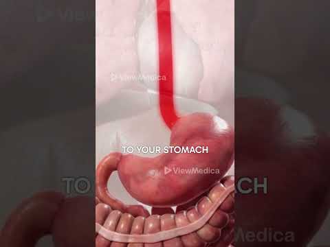 What is Barrett's Esophagus? (3D Animation)