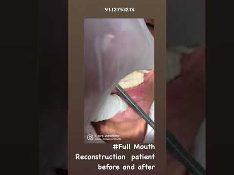 #dentistry#rootcanaltreatment#dentalcare#dentistrymyworld