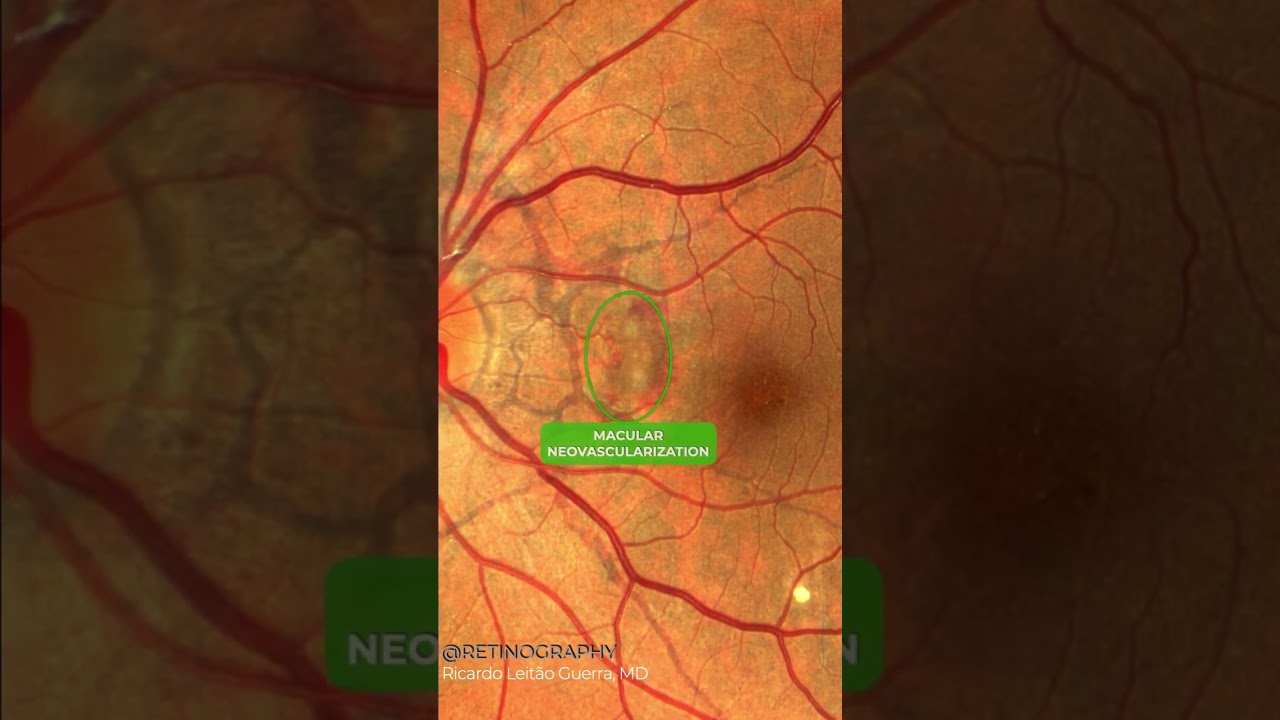 Angioid streaks + macular neovascularization #retina #oftalmo #ophthalmology #oftalmologia #oftalm