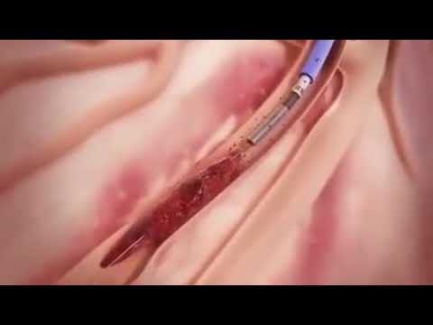 What is hart Angiography??????