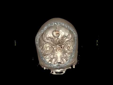 Calcified meningioma volume rendered images
