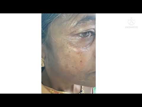 case of - Herpes zoster ophthalmicus