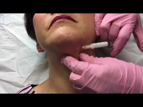 Fat Dissolving Injection, for removing a double chin