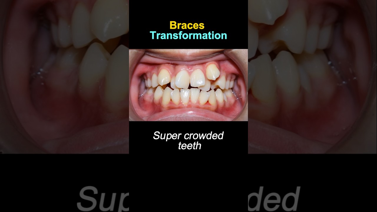 Braces fix all problem crooked teeth #braces #orthodontist #dentist #dentisty
