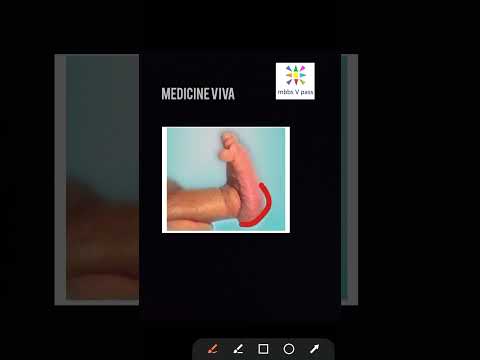 Medicine Rocker bottom feet trisomy 18 edward syndrome