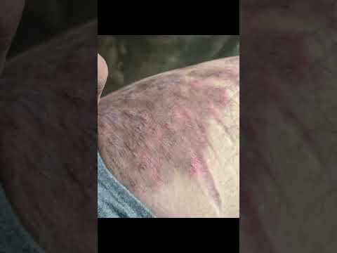 Fungal Infection of Hidden site and its etiological agent Finding_