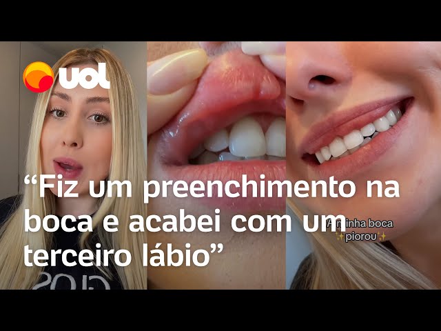 'Decidi fazer um preenchimento na boca e acabei com um terceiro lábio'