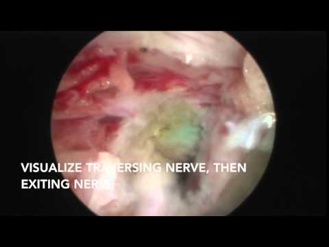 Medical Tourism: Foraminal Herniated Disc Operating in the Axilla