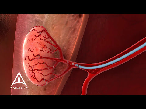 Uterine Fibroid Embolization (UFE) - surgery animation