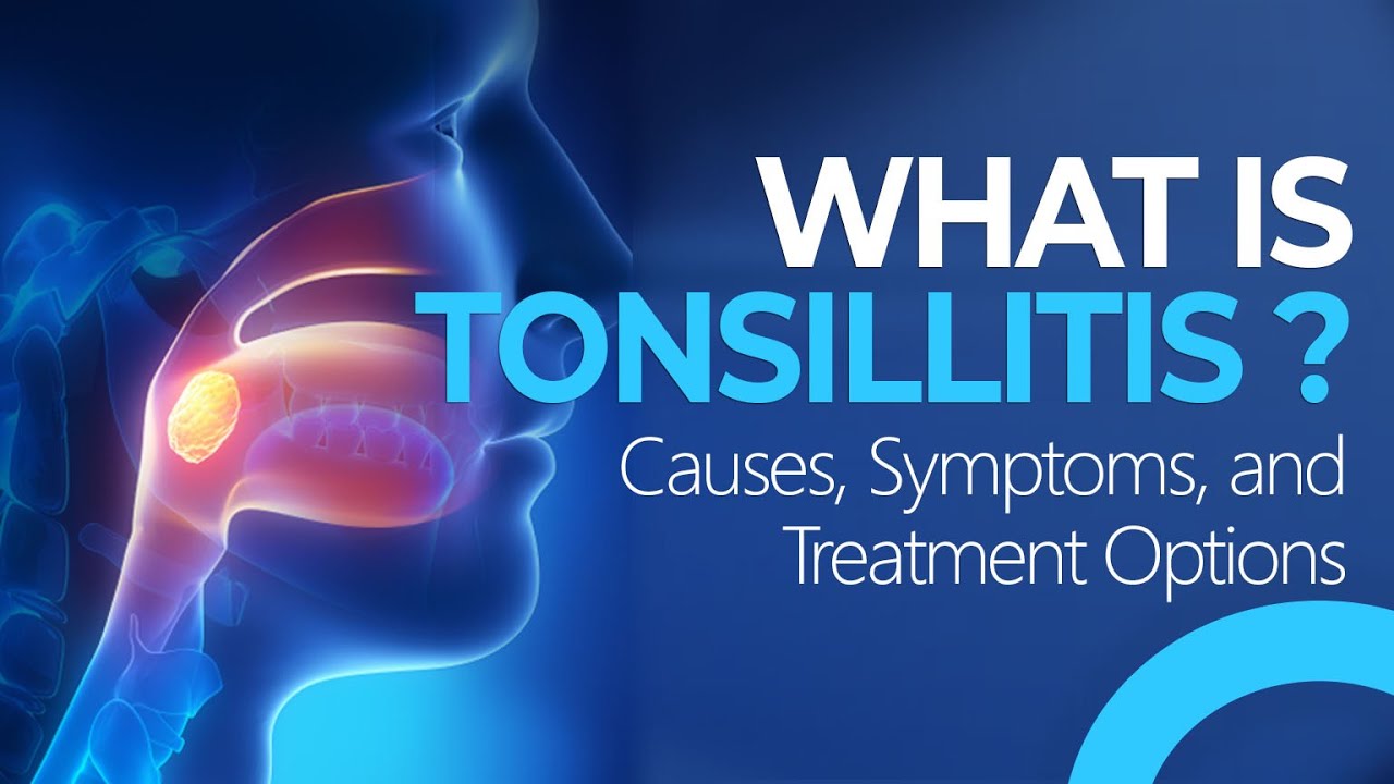 Tonsillitis Explained: Causes, Symptoms & Treatment | Viral vs. Bacterial
