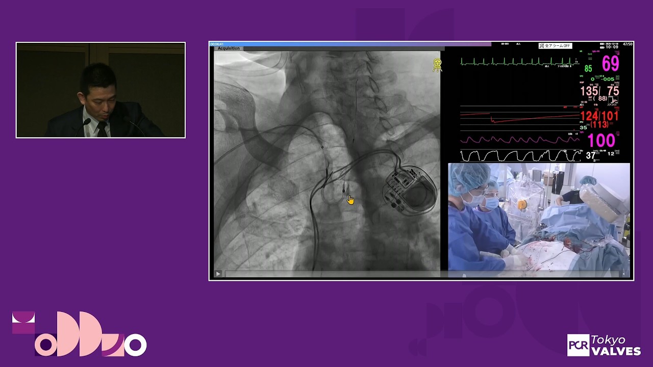 Structural heart disease therapy - Cutting-edge stroke prevention devices: WATCHMAN × SENTINEL