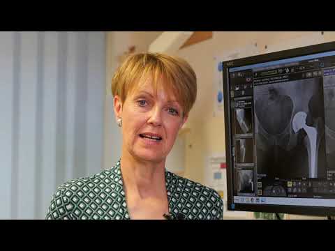 Clinical effectiveness for long-term follow-up of hip arthroplasty - Video abstract [ID 199183]