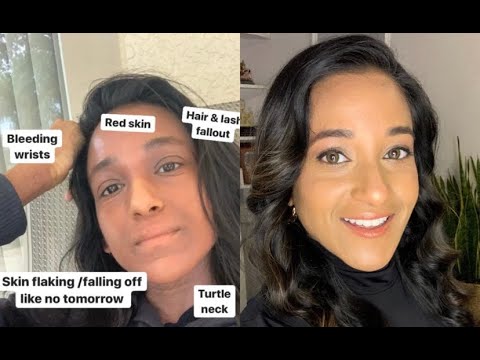 ITSAN talks with Rakhi Roy about Healing Techniques for Topical Steroid Withdrawal (TSW)