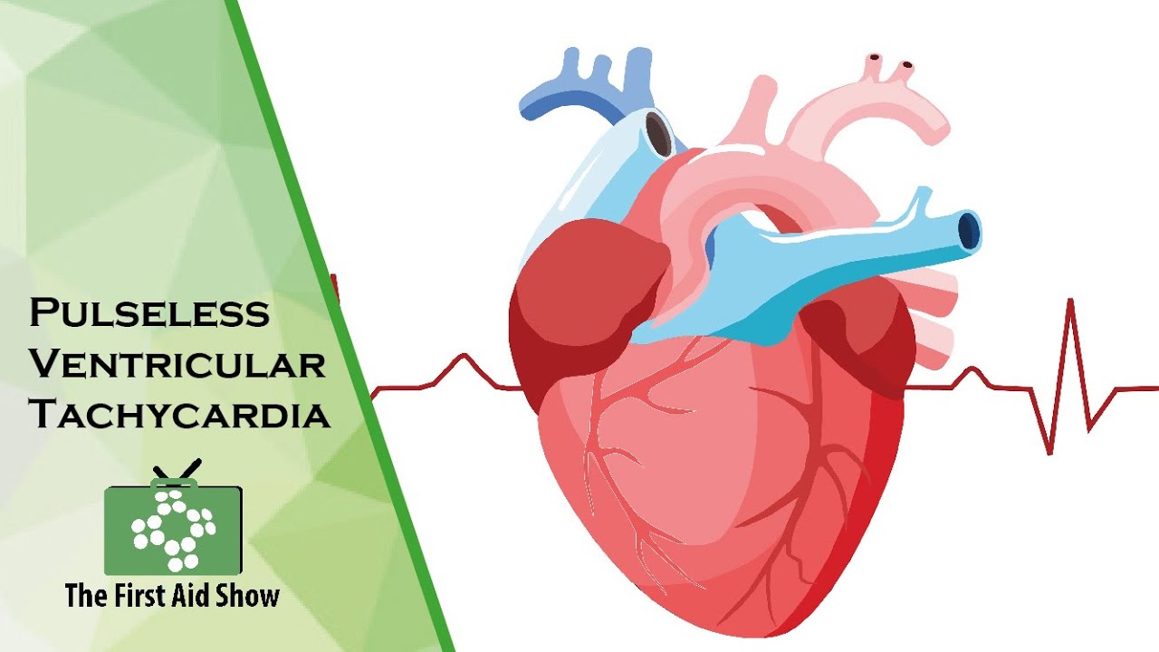 Pulseless Ventricular Tachycardia