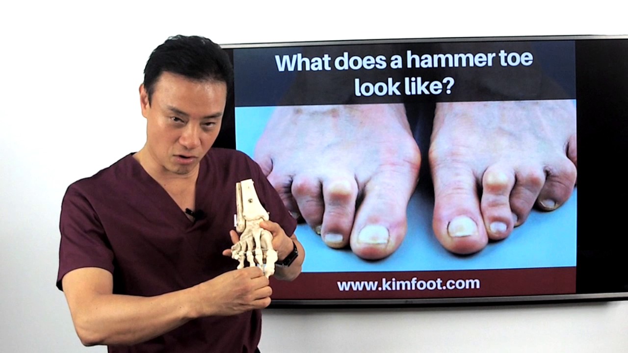 What does hammer toe look like?