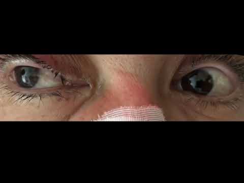 Ocular Dipping in Anoxic Brain Injury