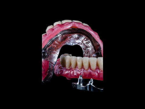 Is there a metallic taste from the implant's titanium bar?