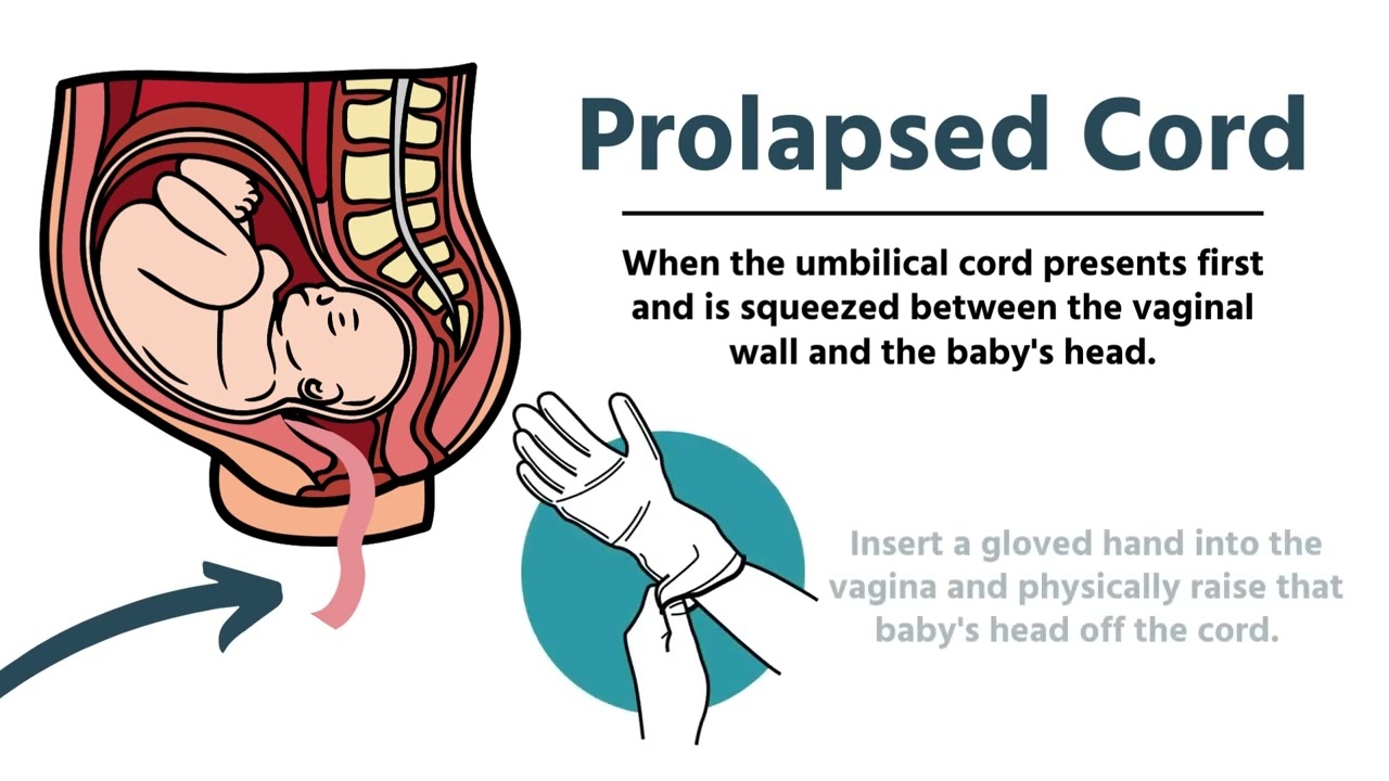 Pregnancy & Delivery Emergencies in EMS