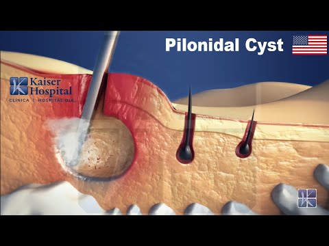 E.P.Si.T. - Endoscopic Pilonidal Sinus Treatment