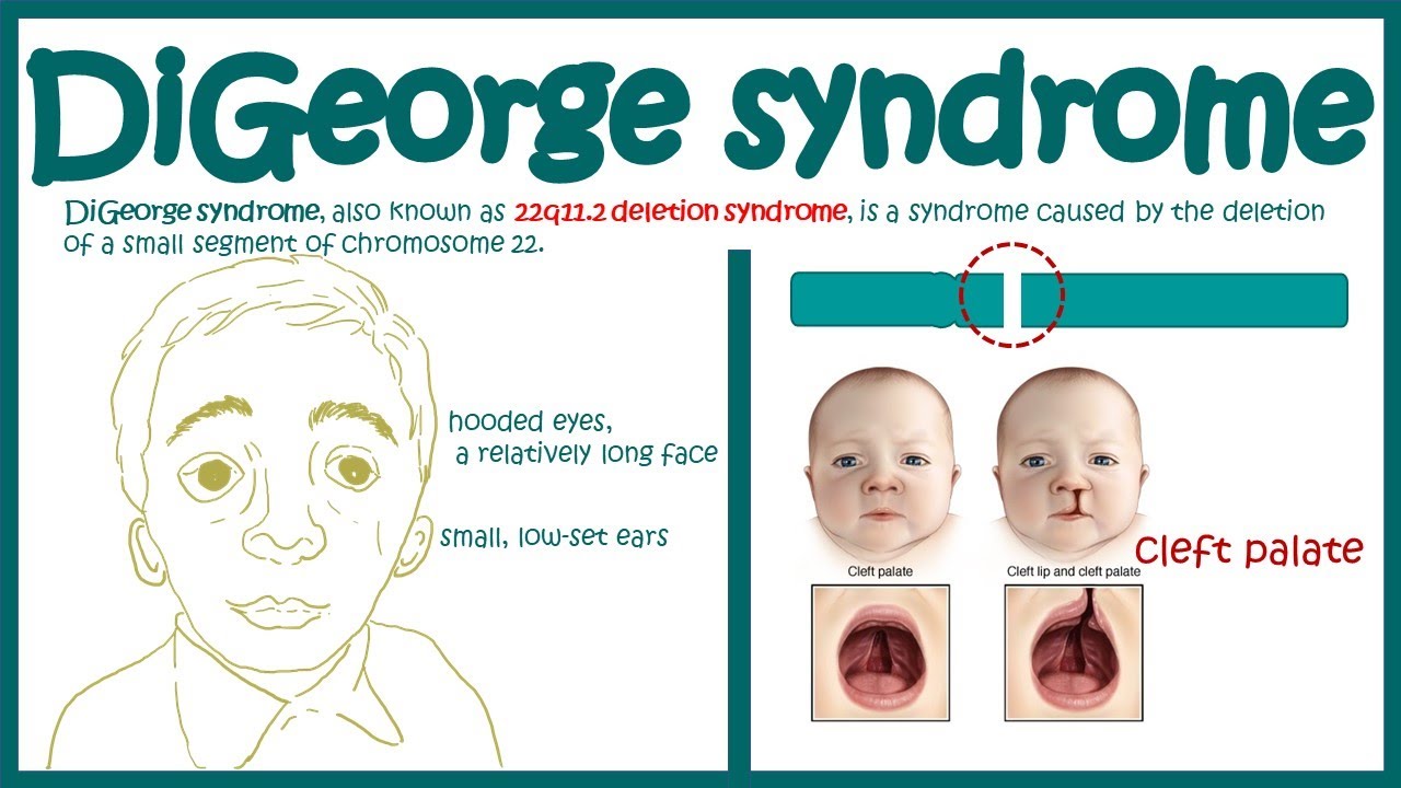 DiGeorge syndrome || 22q11. 2 deletion syndrome || Immunodeficiency