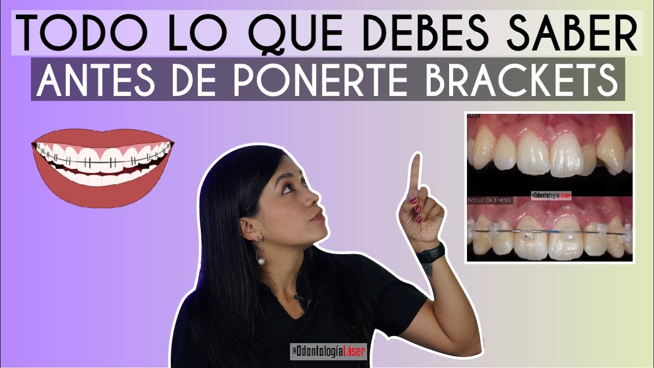 Cosas que debes Saber Antes de ponerte los Brackets 😬 ¿Qué necesito? - Odontología Láser