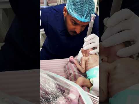 Successful intubation of a baby {endotracheal tube }#ankur maitrika hospital jammu