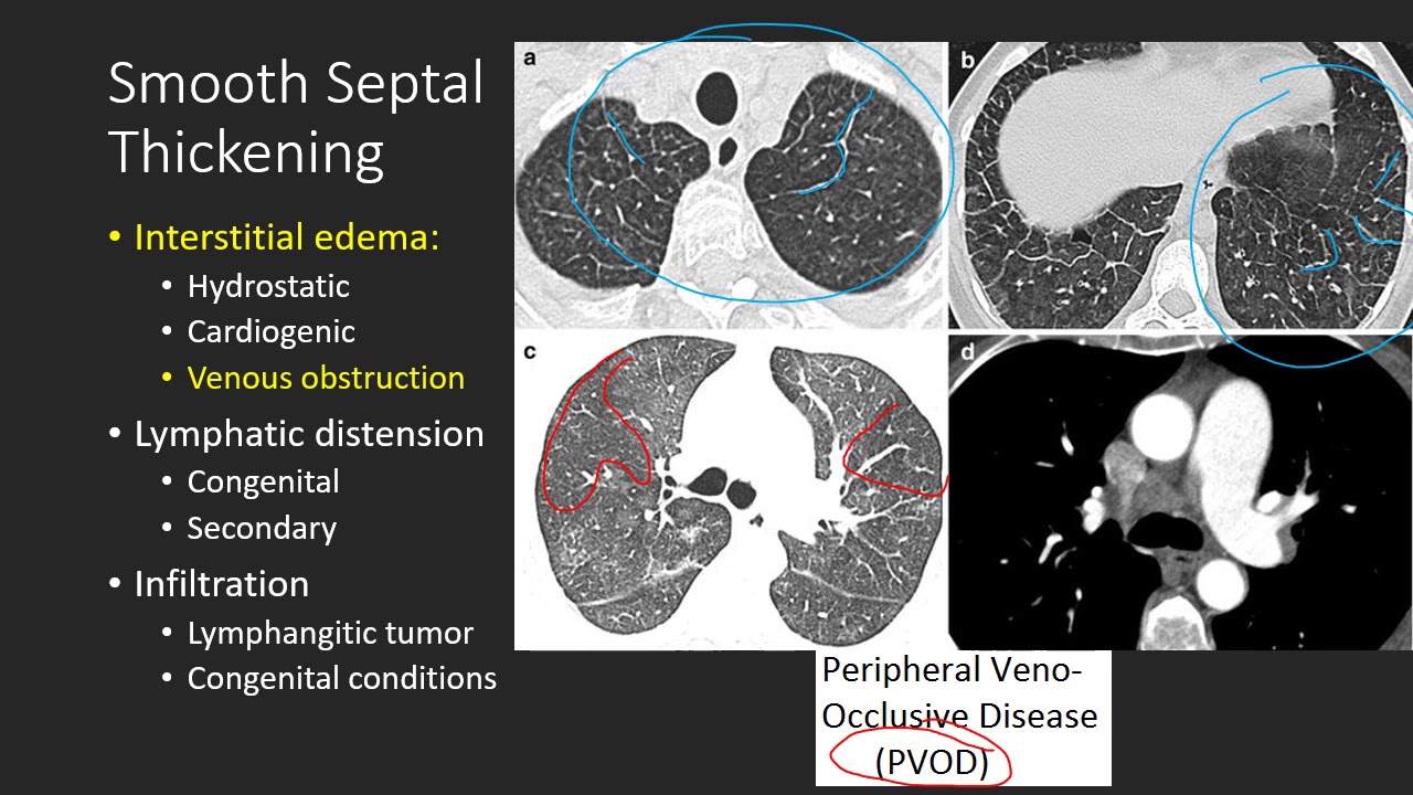 Septal Thickening