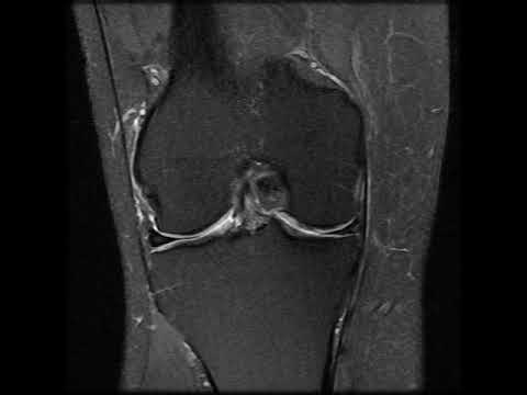 MRI of Right Knee (CORPD FS) With SatPad⢠By Clinical Imaging Solutions