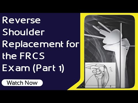 Reverse Shoulder Arthroplasty for FRCS Ortho Exam | Biomechanics | Orthopaedic Academy