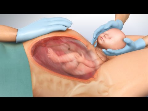 Postpartum Hemorrhage