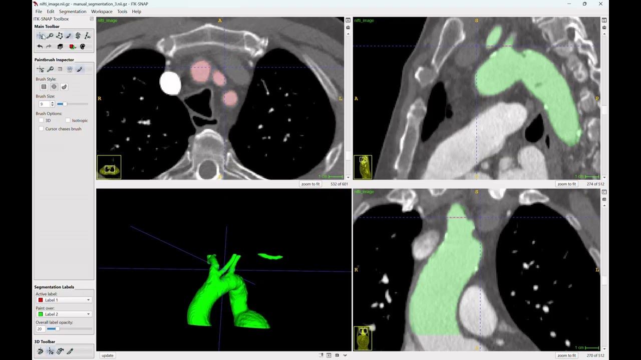 Semi-Automatic Segmentation using ITK-SNAP - Tutorial