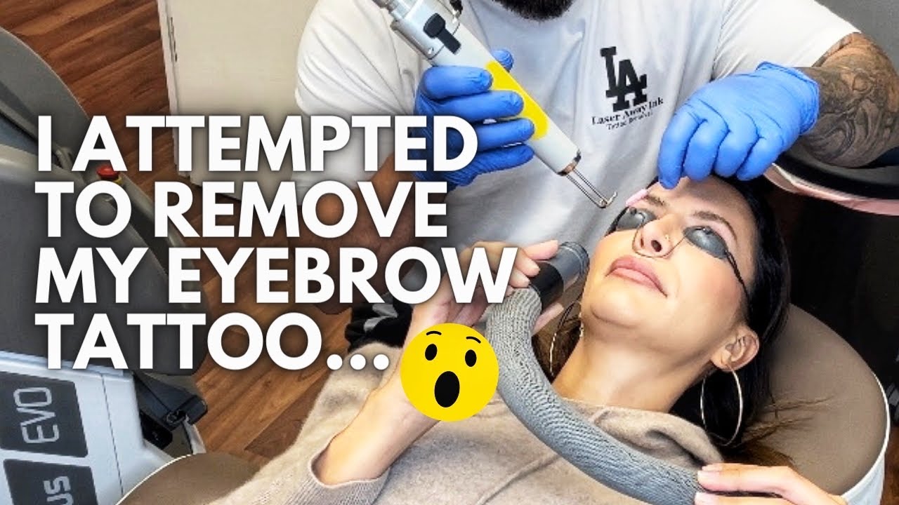 I got my Eyebrow Tattoo Removed | They turned green...