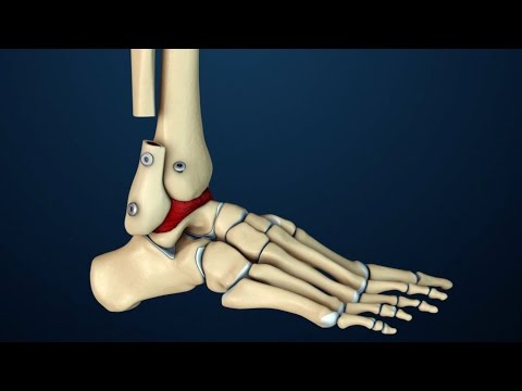 Transfibular Ankle Fusion Surgery (Arthrodesis) This 3D medical ...