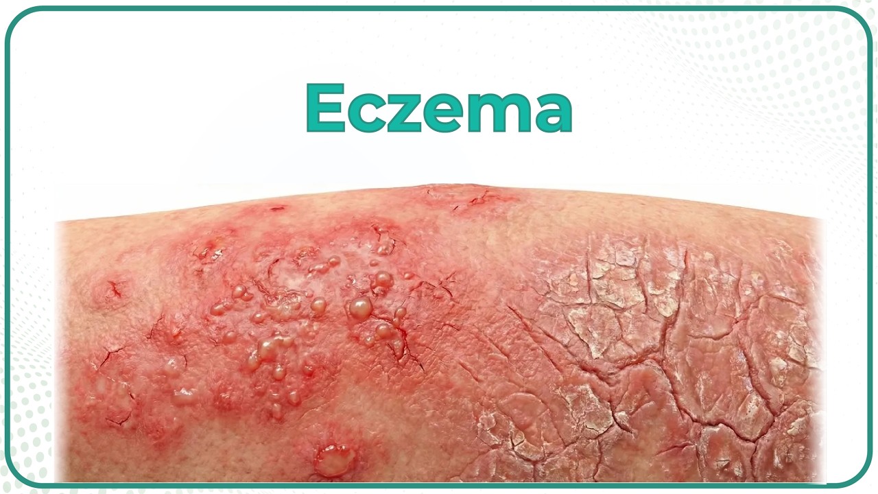 Eczema: Introduction, Classification, Grading, Lichenification, Management